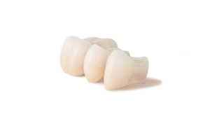 Crowns & Bridges: How They Work | Point Richmond Dental Studio | Point ...